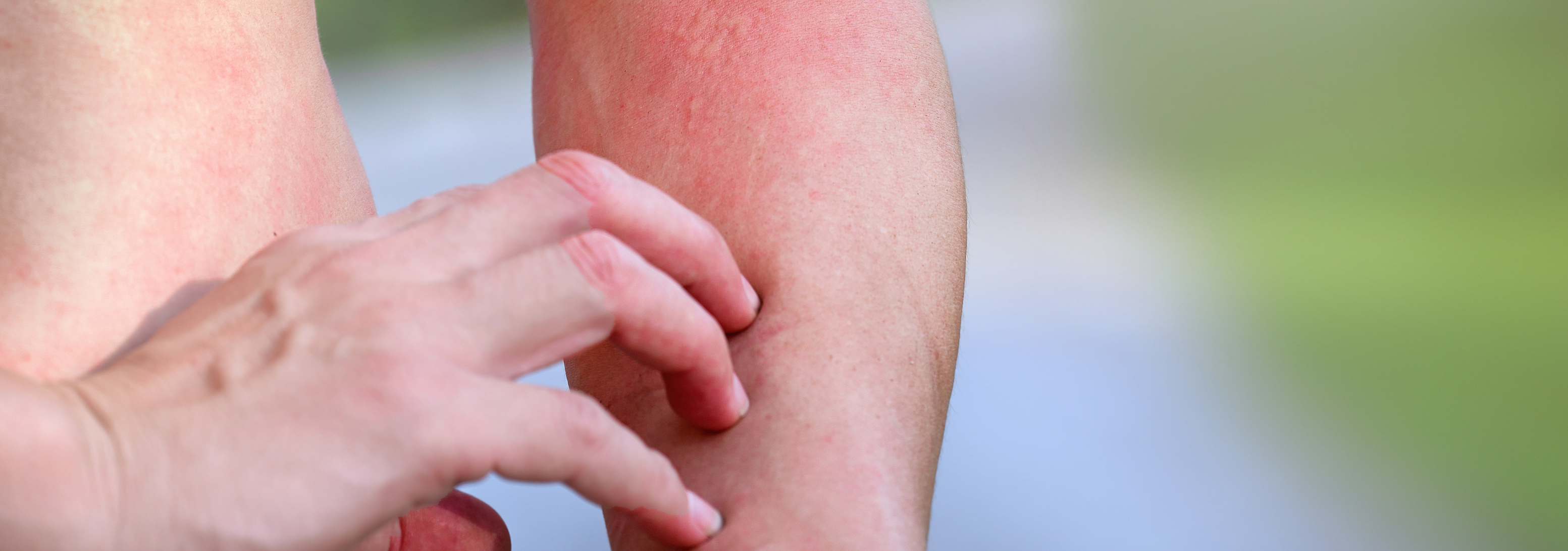 Scabies - Independent Pharmacies Australia